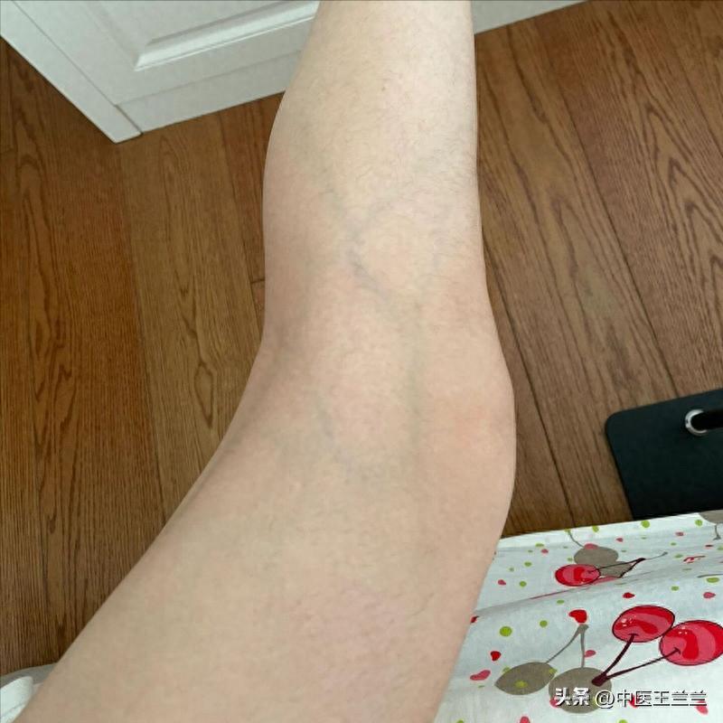 Bulging blue veins on the legs, don’t fear varicose veins — just boil ...