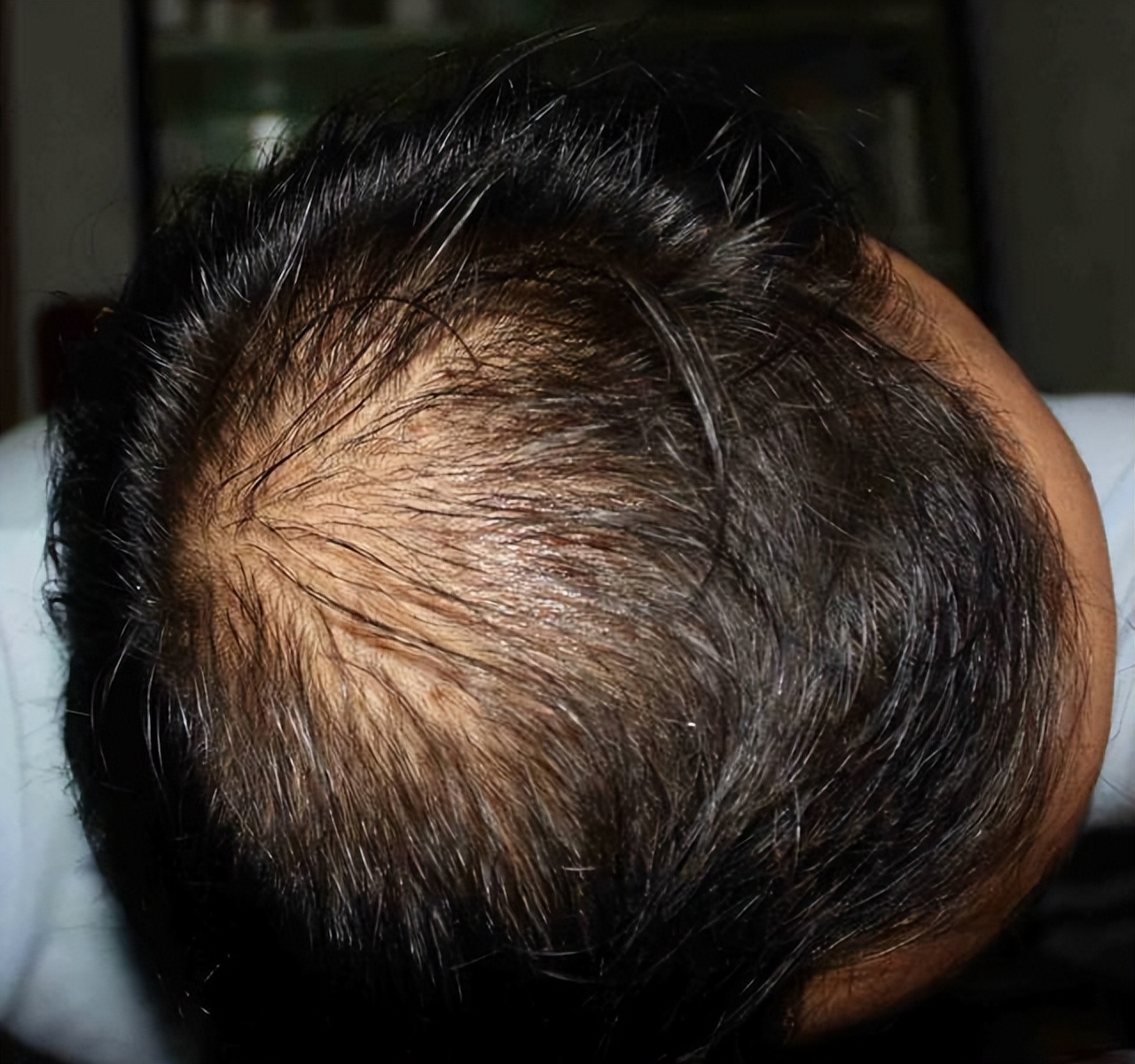 Hair Loss, Blurred Vision, and Numbness in Limbs are all Signs of Blood ...