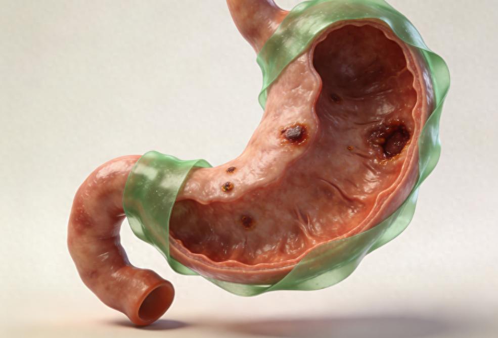 Use This Medication for Gastric Pain and Gastric Ulcers—Repairs Gastric ...